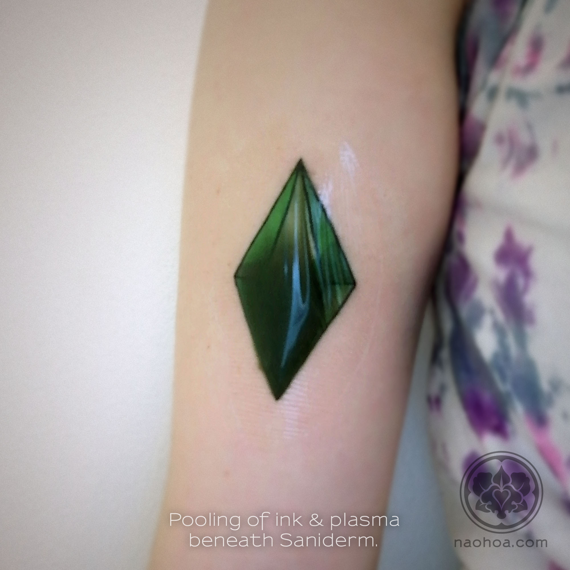 What to Expect When Using Saniderm – NAOHOA